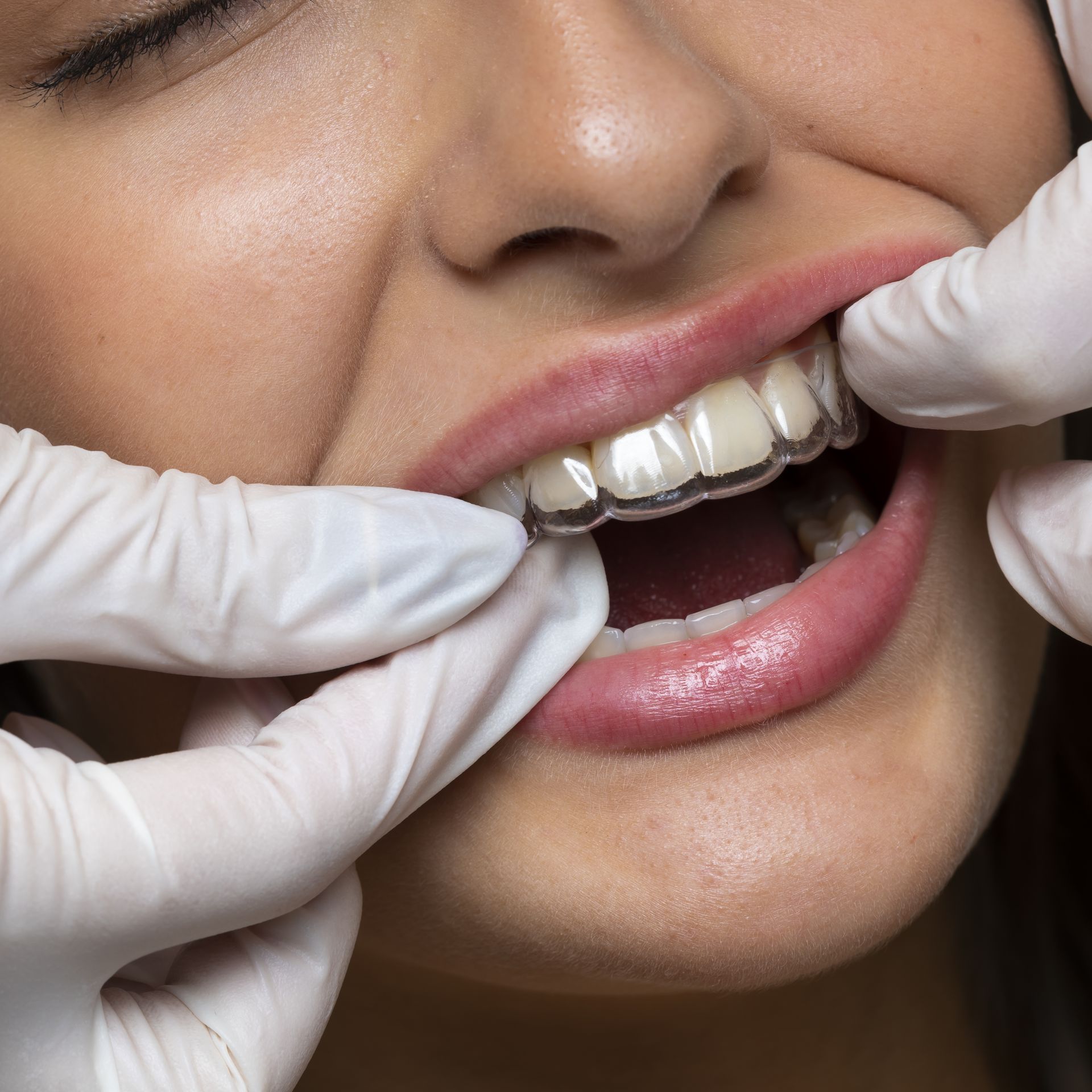 Aligner aftercare | Lumi Aligners