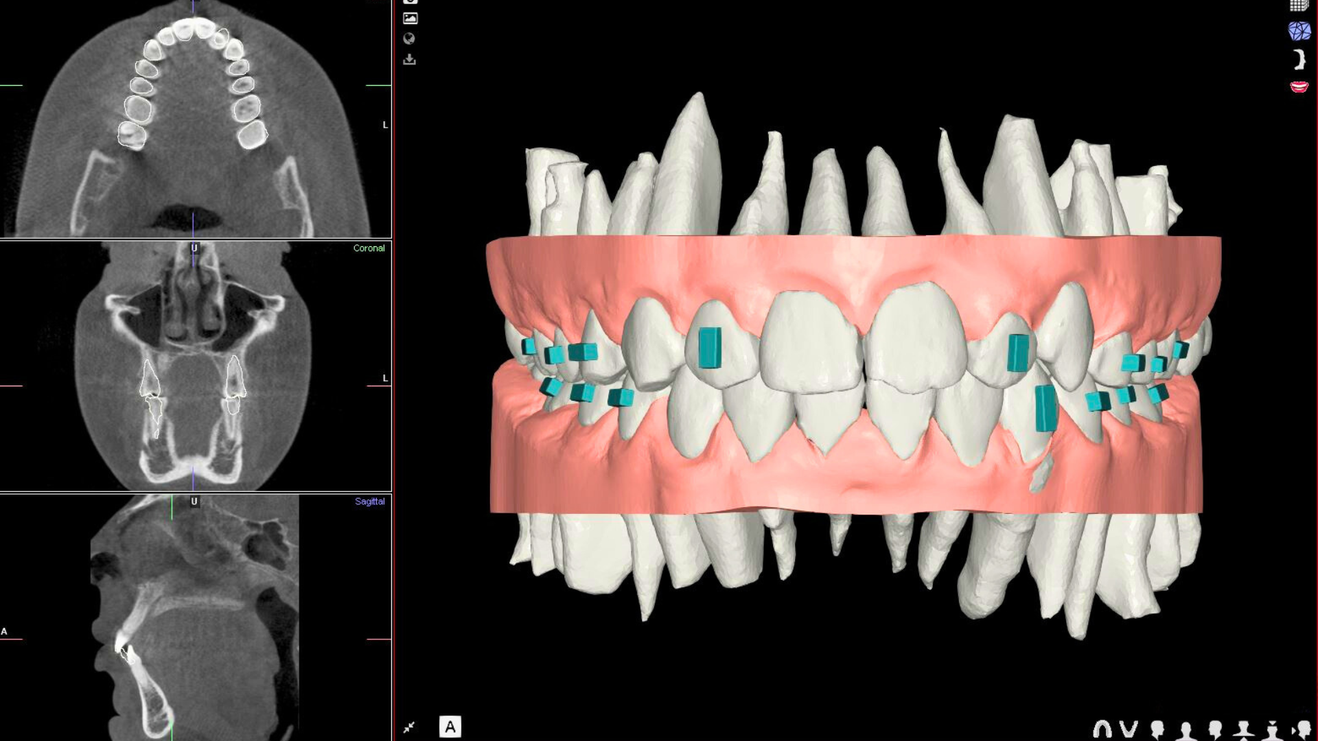 50 Perc off | Lumi Aligners